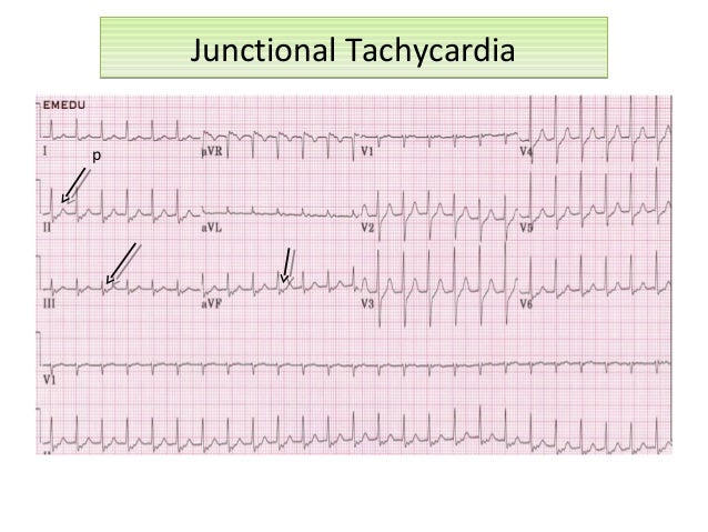 ECG Atrial and Junctional rhythms Dr Sarfaraz