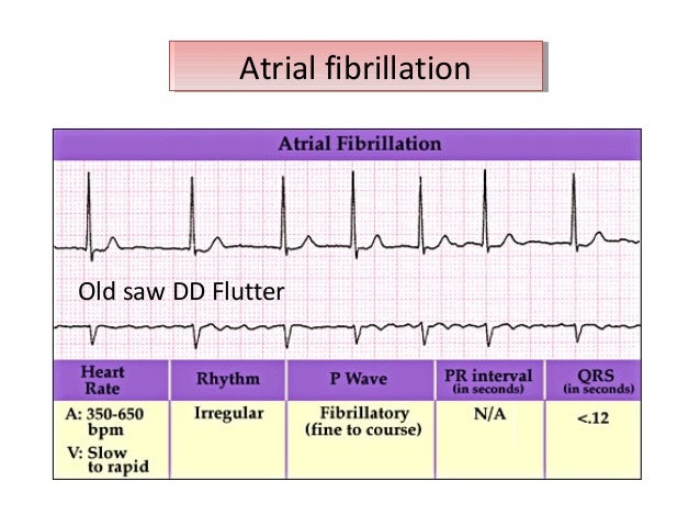 ECG Atrial and Junctional rhythms Dr Sarfaraz