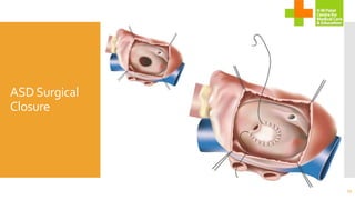 Atrial level shunts | PPTX