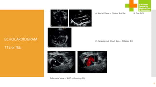 Atrial level shunts | PPTX