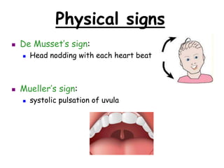 Atrial regurgitation | PPTX
