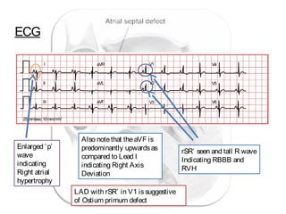 Atrial septal defect | PPT
