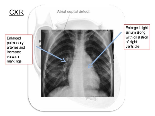 Atrial Septal Defect Chest X Ray Wikidoc