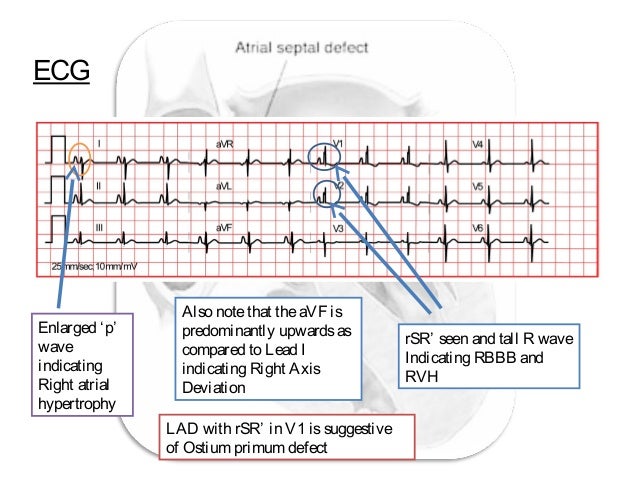 Atrial septal defect