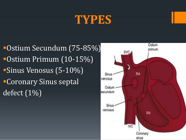 Atrial septal defect