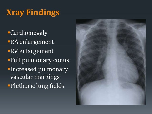 Atrial septal defect