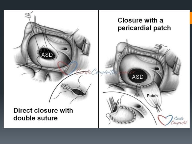 Atrial septal defect