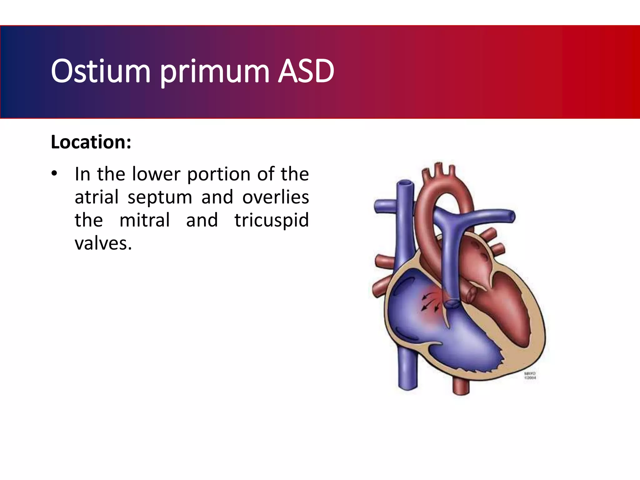 Atrial septal defect | PPTX