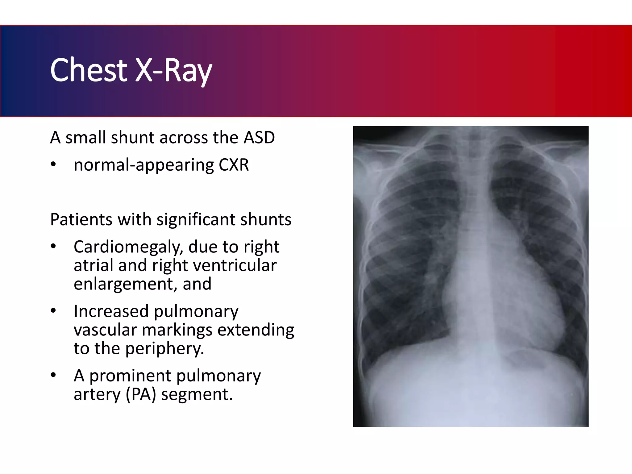 Atrial septal defect | PPTX