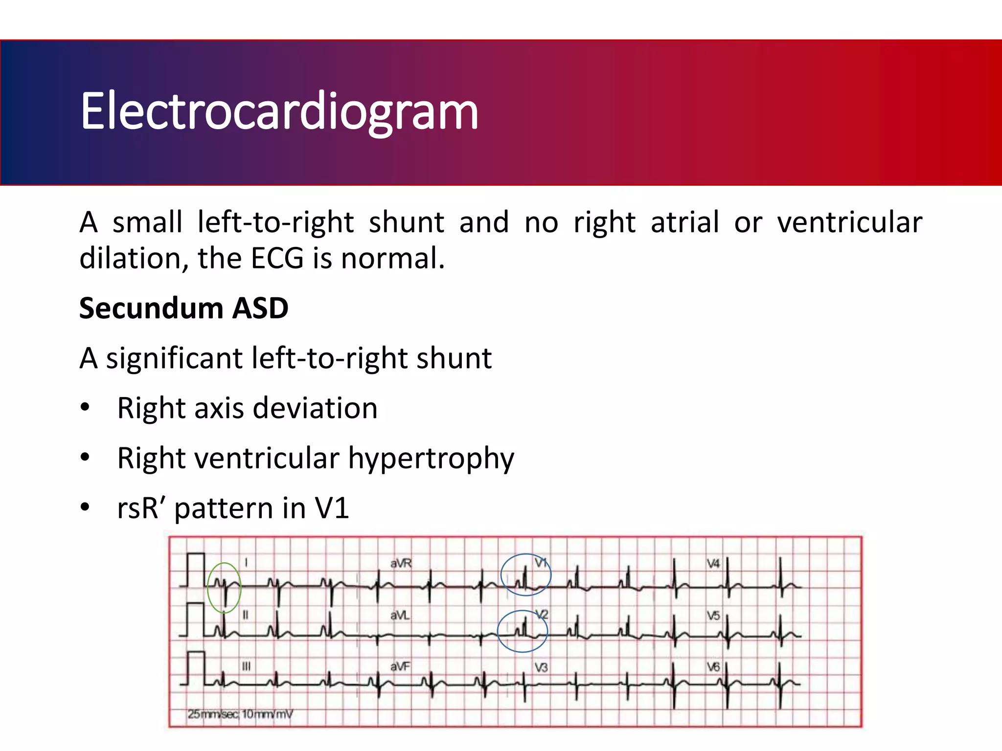 Atrial septal defect | PPTX