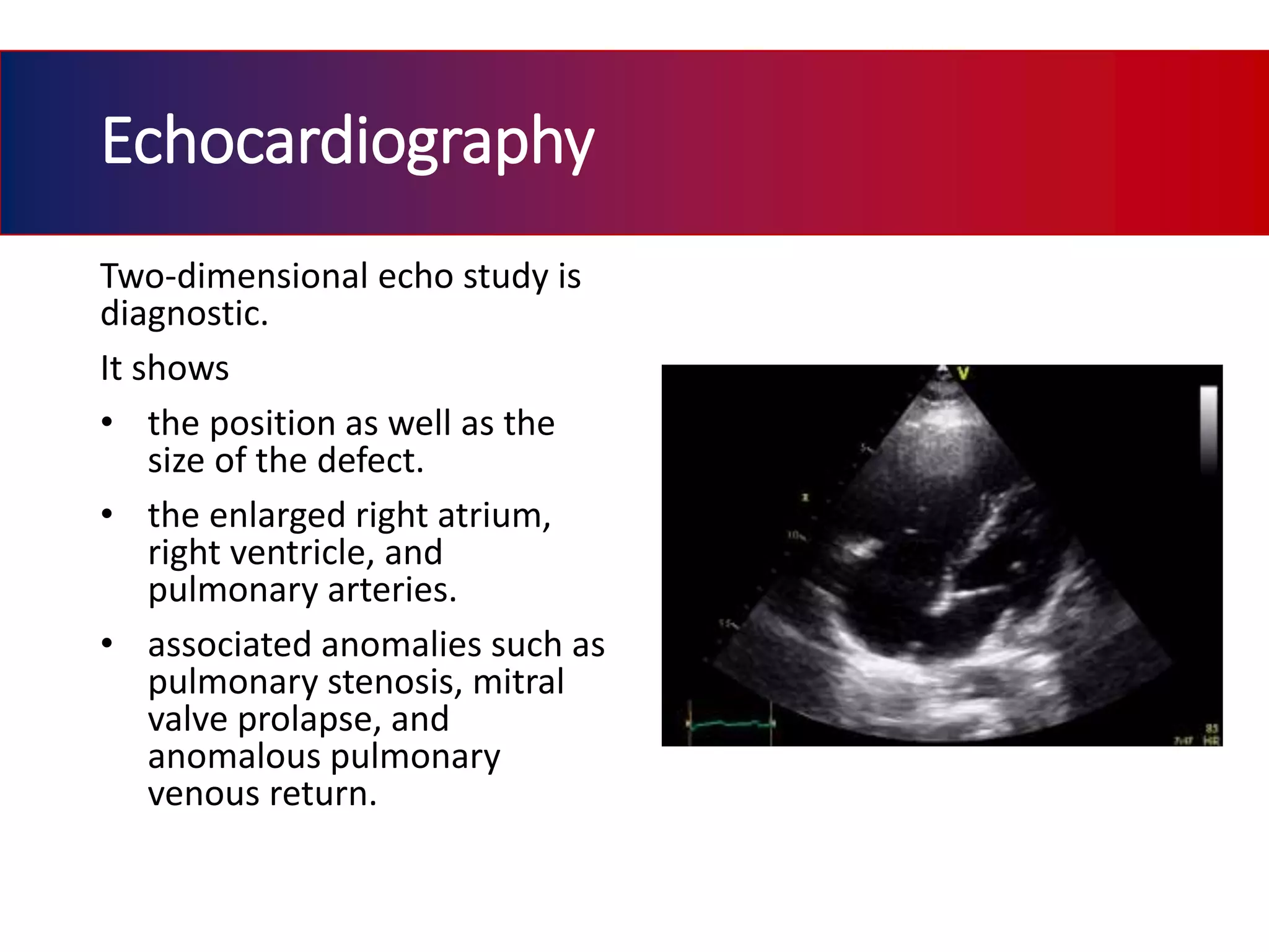 Atrial septal defect | PPTX
