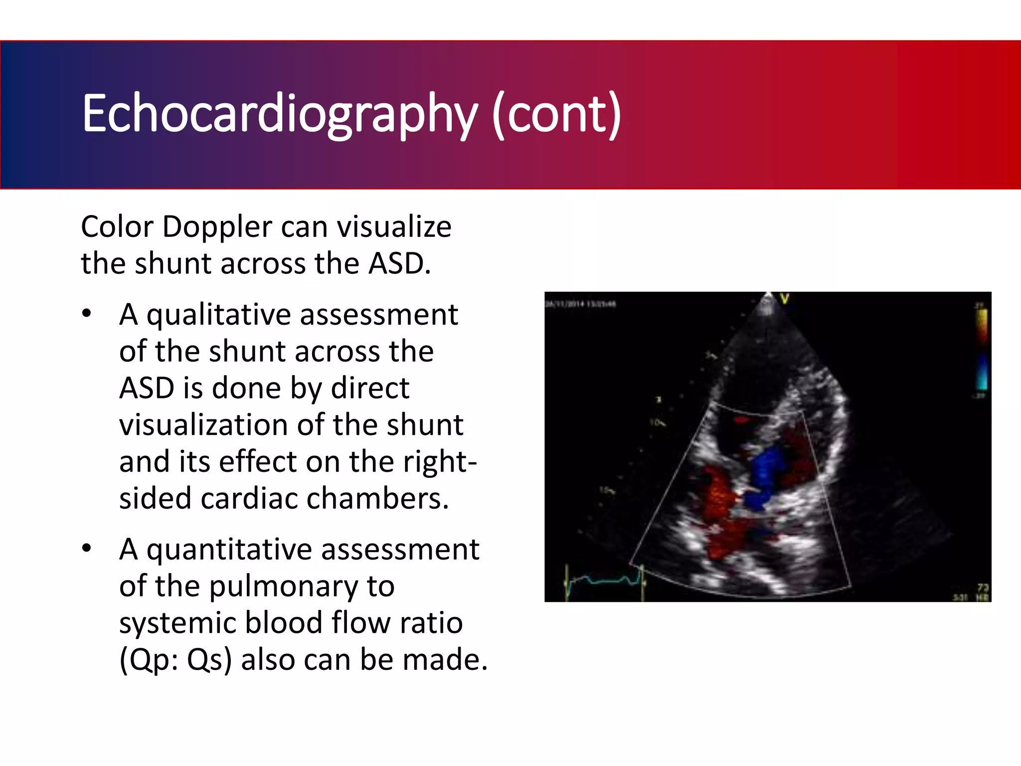 Atrial septal defect | PPTX