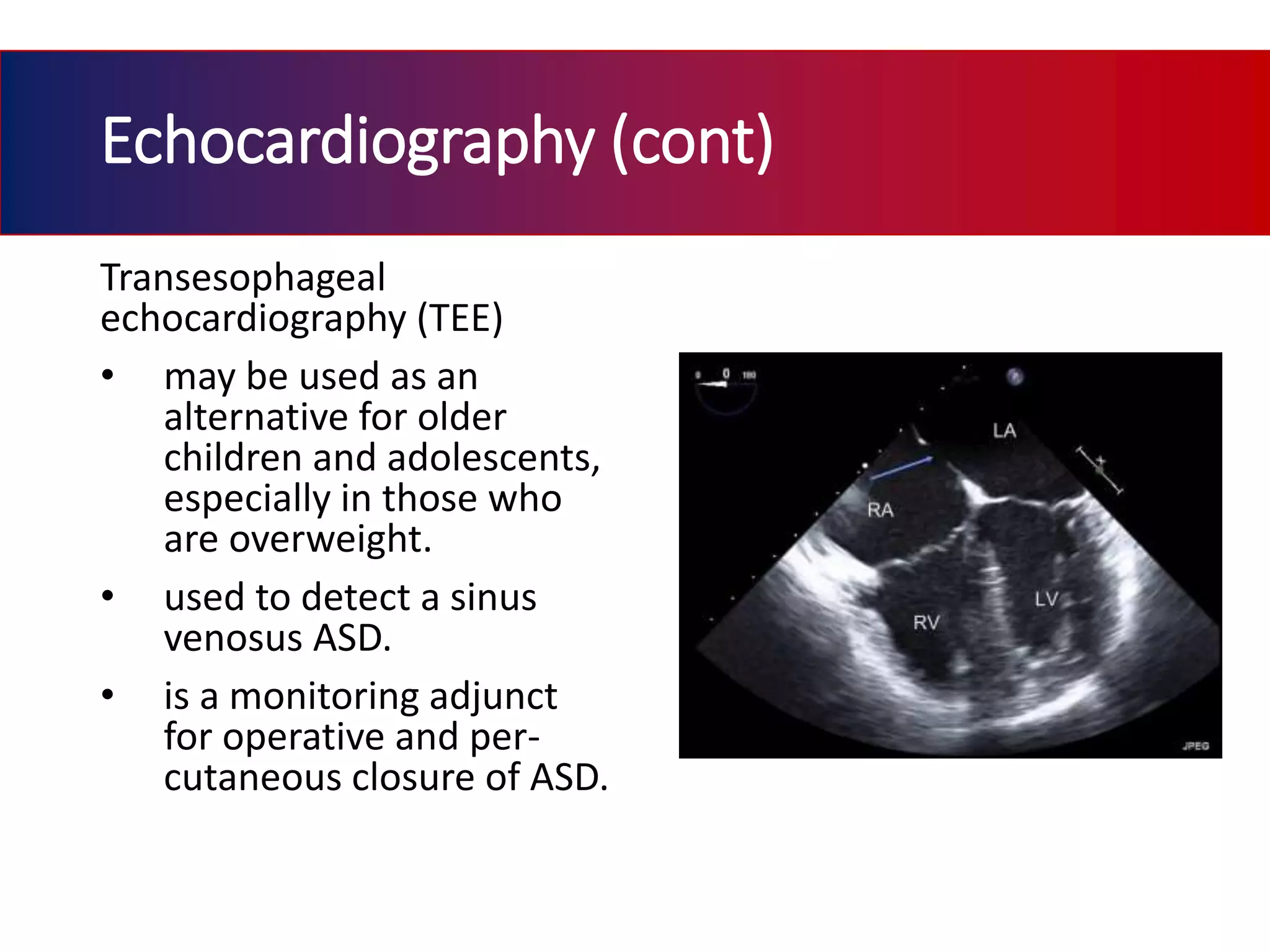 Atrial septal defect | PPTX