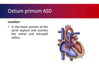 Atrial septal defect | PPTX