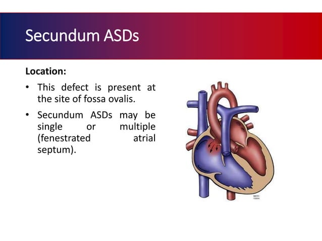 Atrial septal defect | PPTX