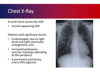 Atrial septal defect | PPT