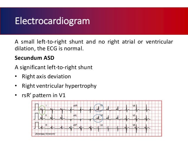 Atrial septal defect