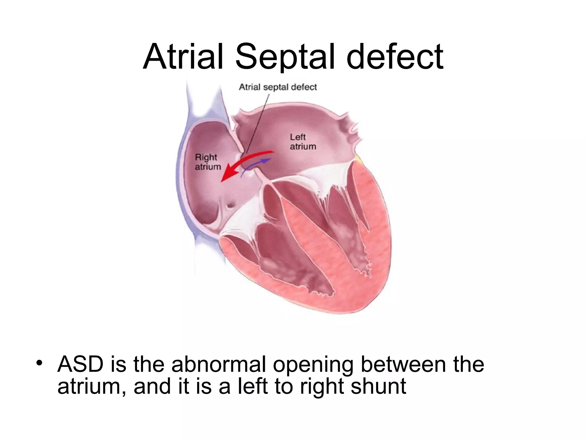 Atrial septal defect | PPT | Heart and Cardiovascular Diseases ...