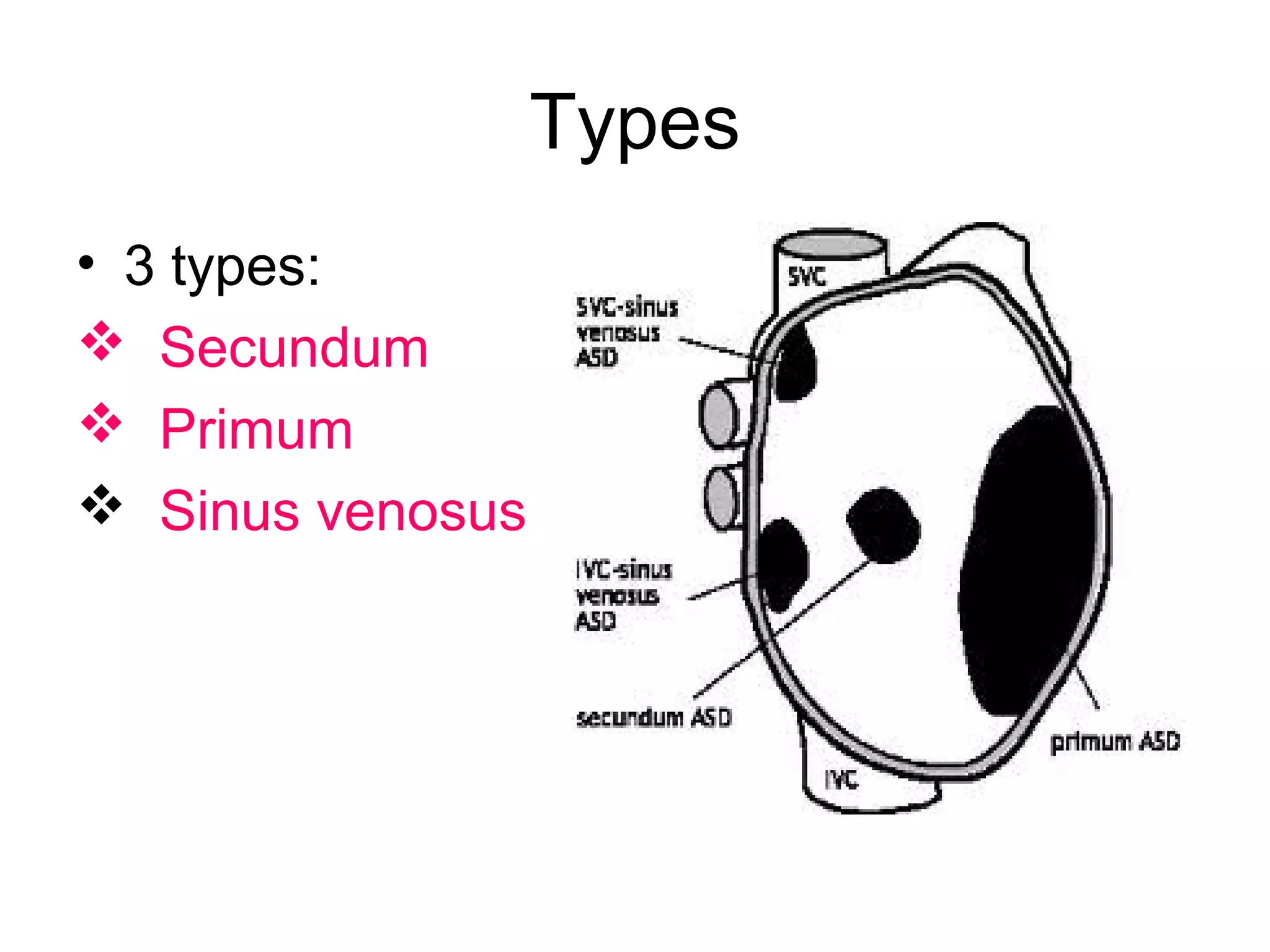 Atrial Septal Defect Ppt