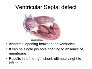 Atrial septal defect | PPT