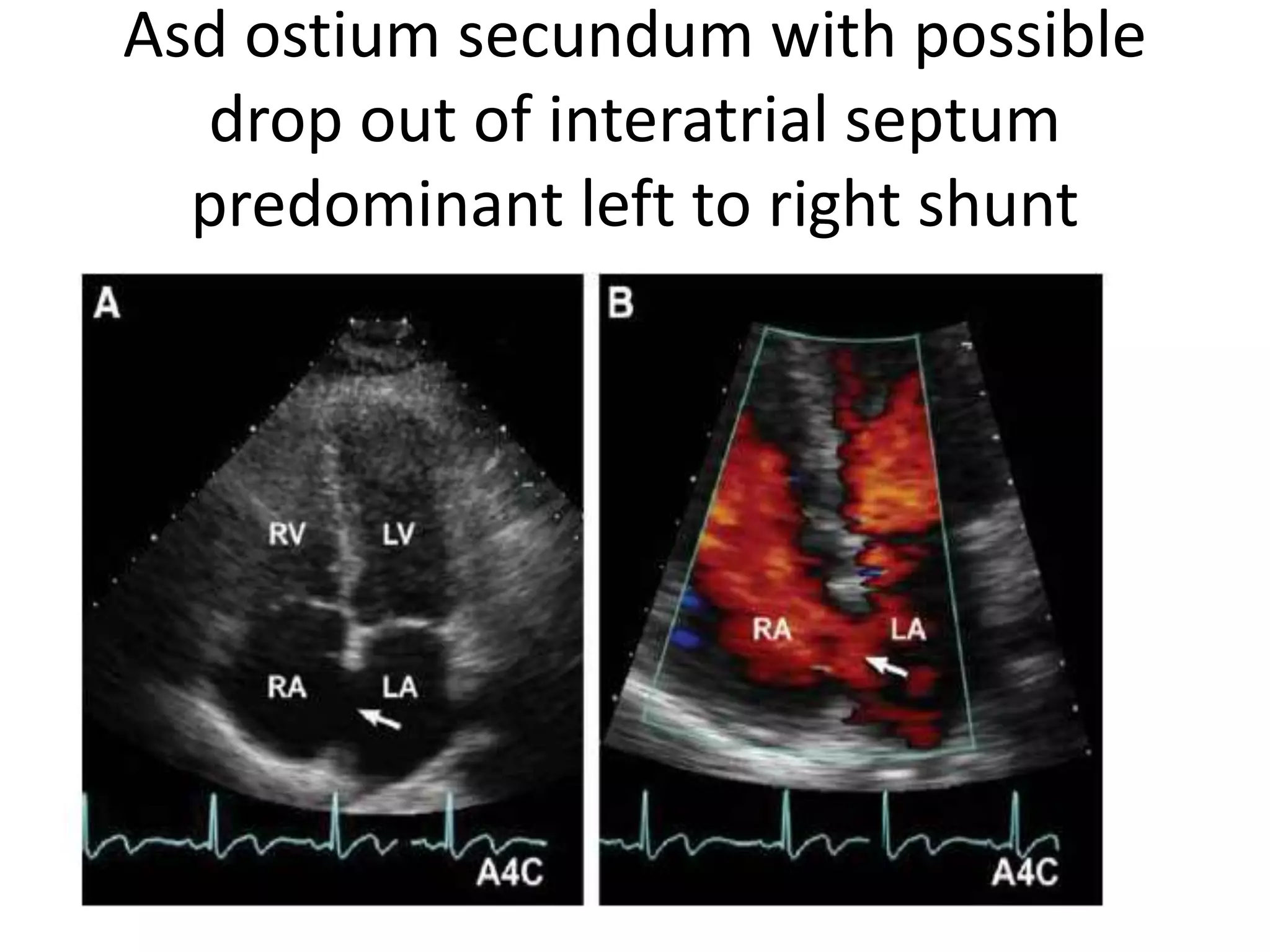 Atrial Septal Defect Echocardiography Pptx