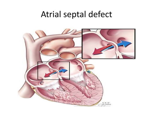 Atrial septal defect Echocardiography | PPTX