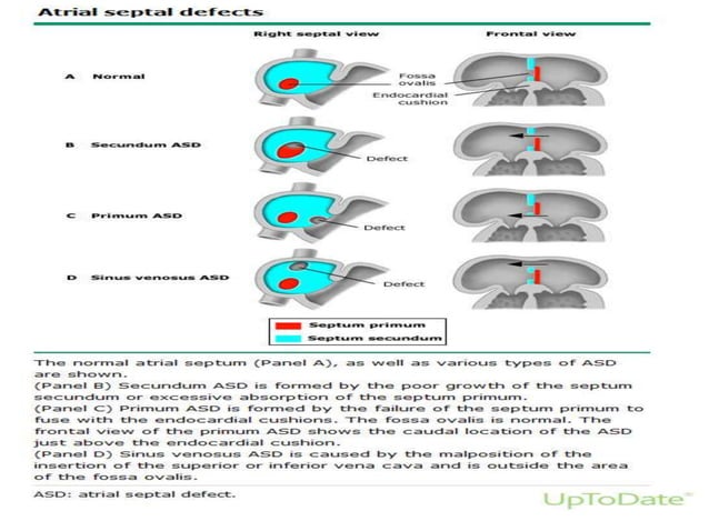 Atrial septal defect Echocardiography | PPTX