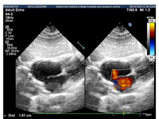 Atrial septal defect Echocardiography | PPTX