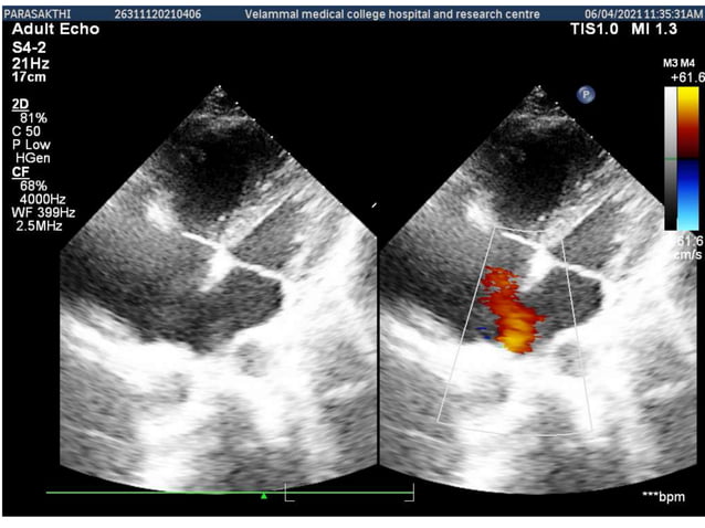 Atrial Septal Defect Echocardiography Pptx