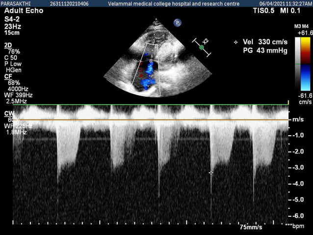 Atrial septal defect Echocardiography | PPTX