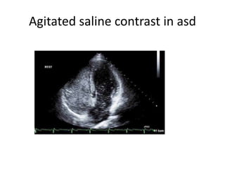 Atrial septal defect Echocardiography | PPTX