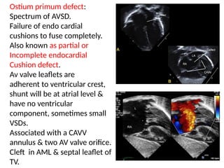 Atrial Septal Defect_Naznin_madam_all_pptx | PPTX