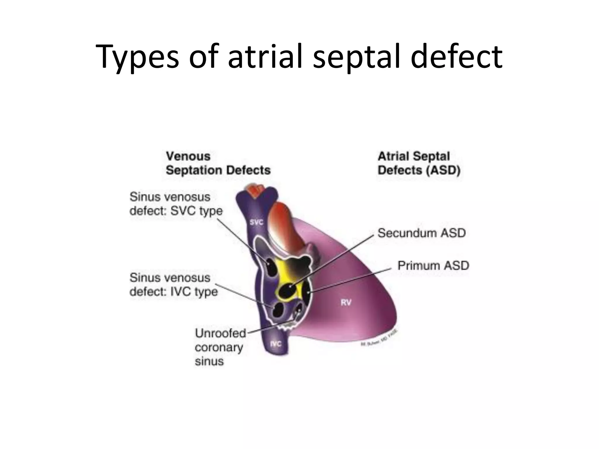 Atrial septal defect | PDF