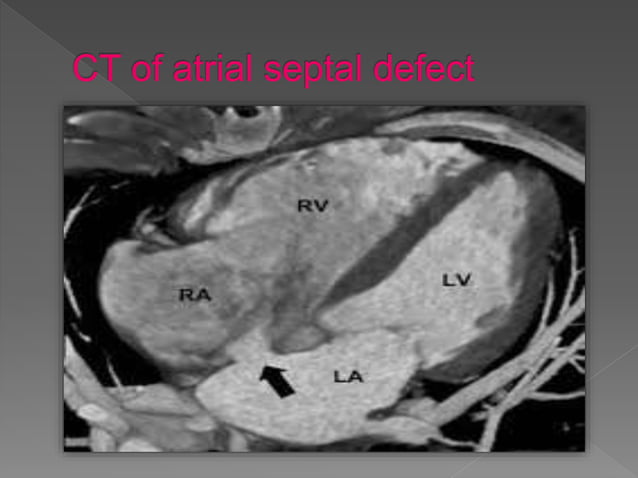 Atrial septal defect raj | PPTX | Heart and Cardiovascular Diseases ...