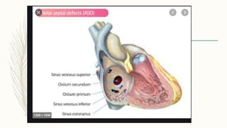 ATRIAL SEPTAL DEFECT Theory part for Pediatrics .pptx