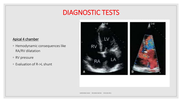Atrial septal defect (ASD) | PPT