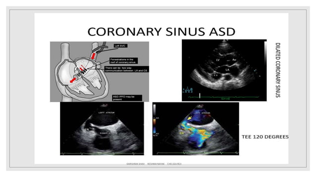 Atrial septal defect (ASD) | PPT