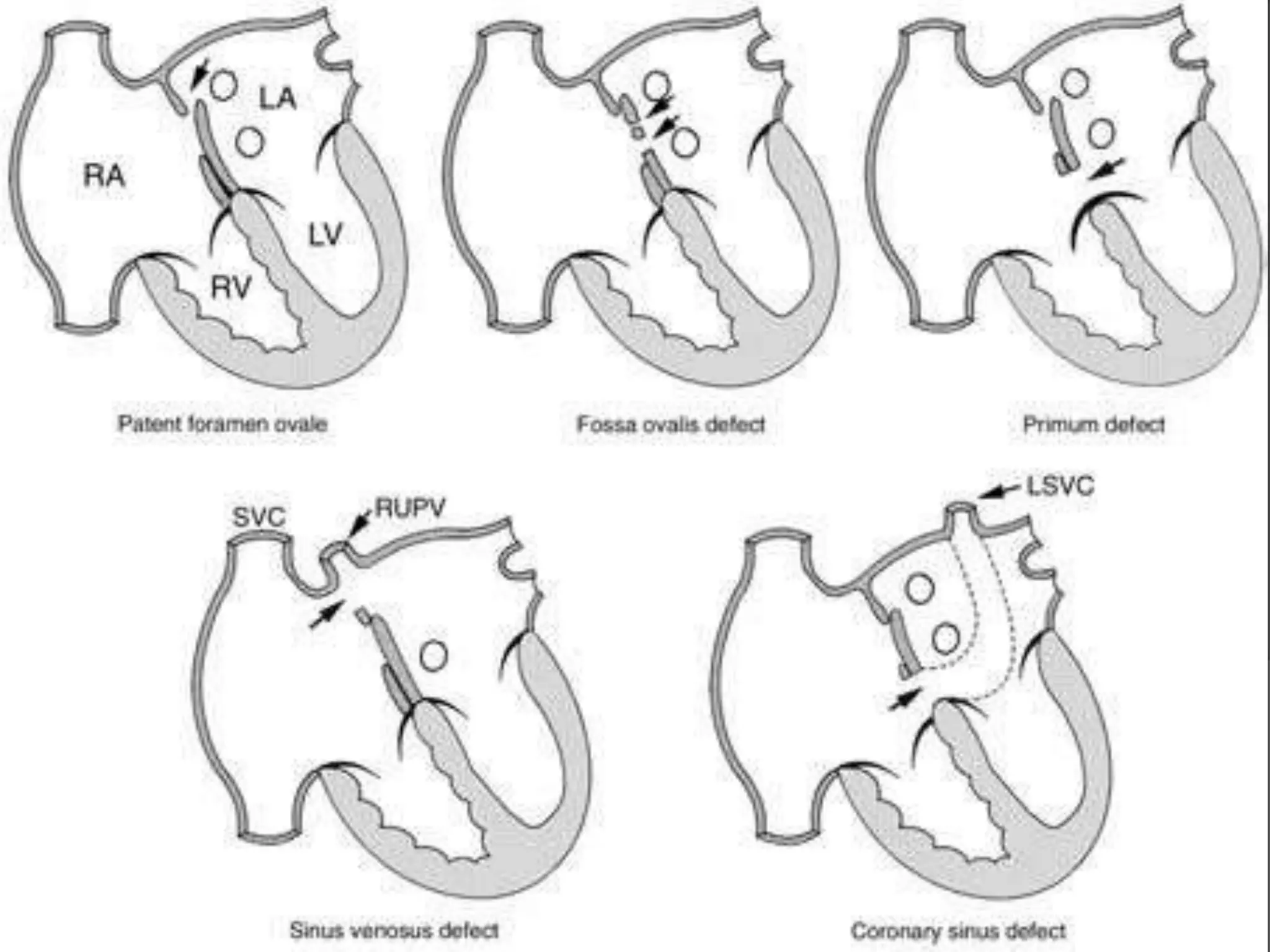Atrial septal defects | PPTX