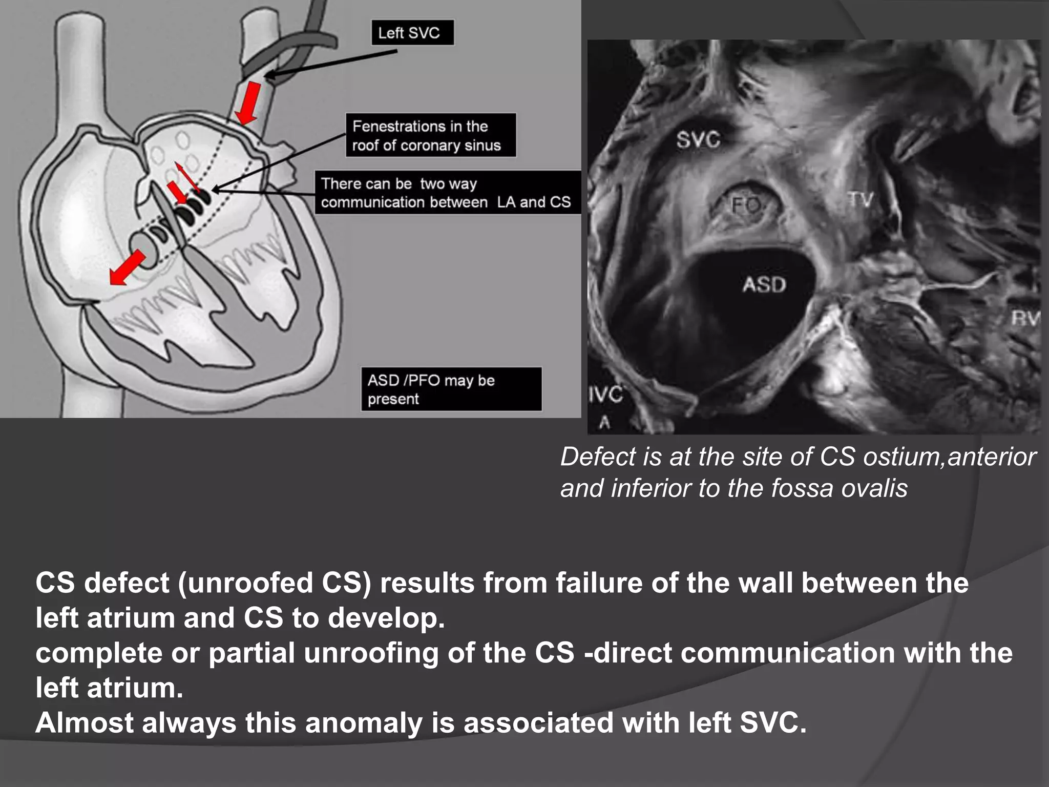 Atrial septal defects | PPTX