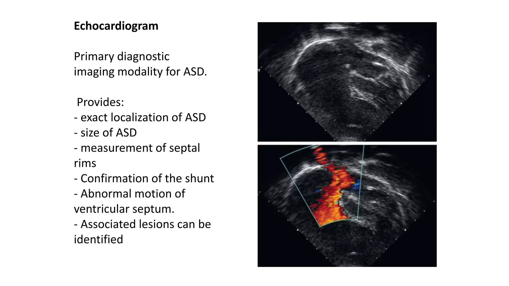 Atrial Septal Defects.pptx