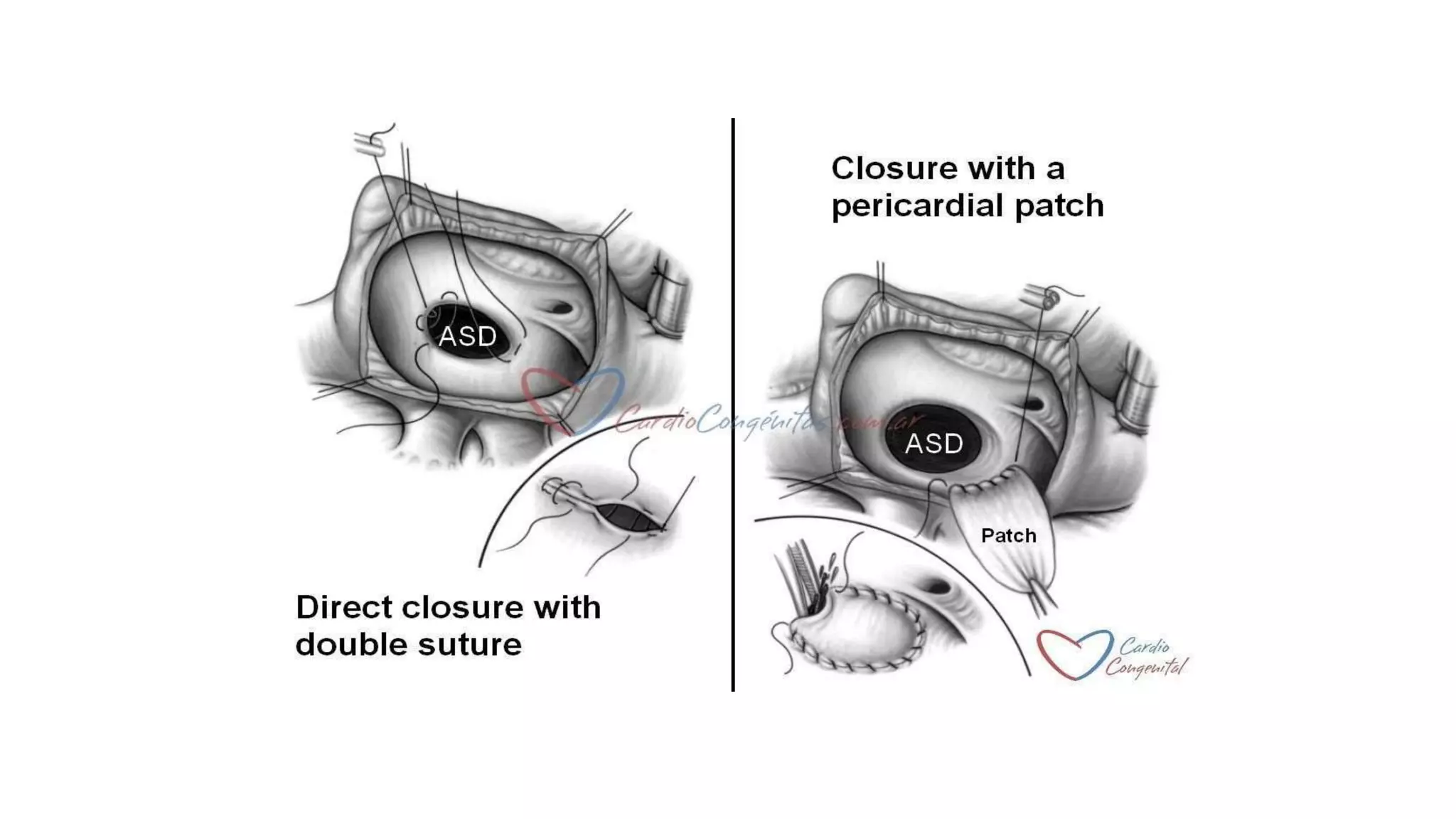 Atrial Septal Defectspptx