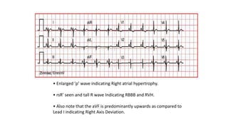 Atrial Septal Defects.pptx