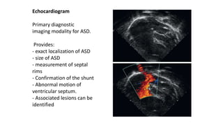 Atrial Septal Defects.pptx