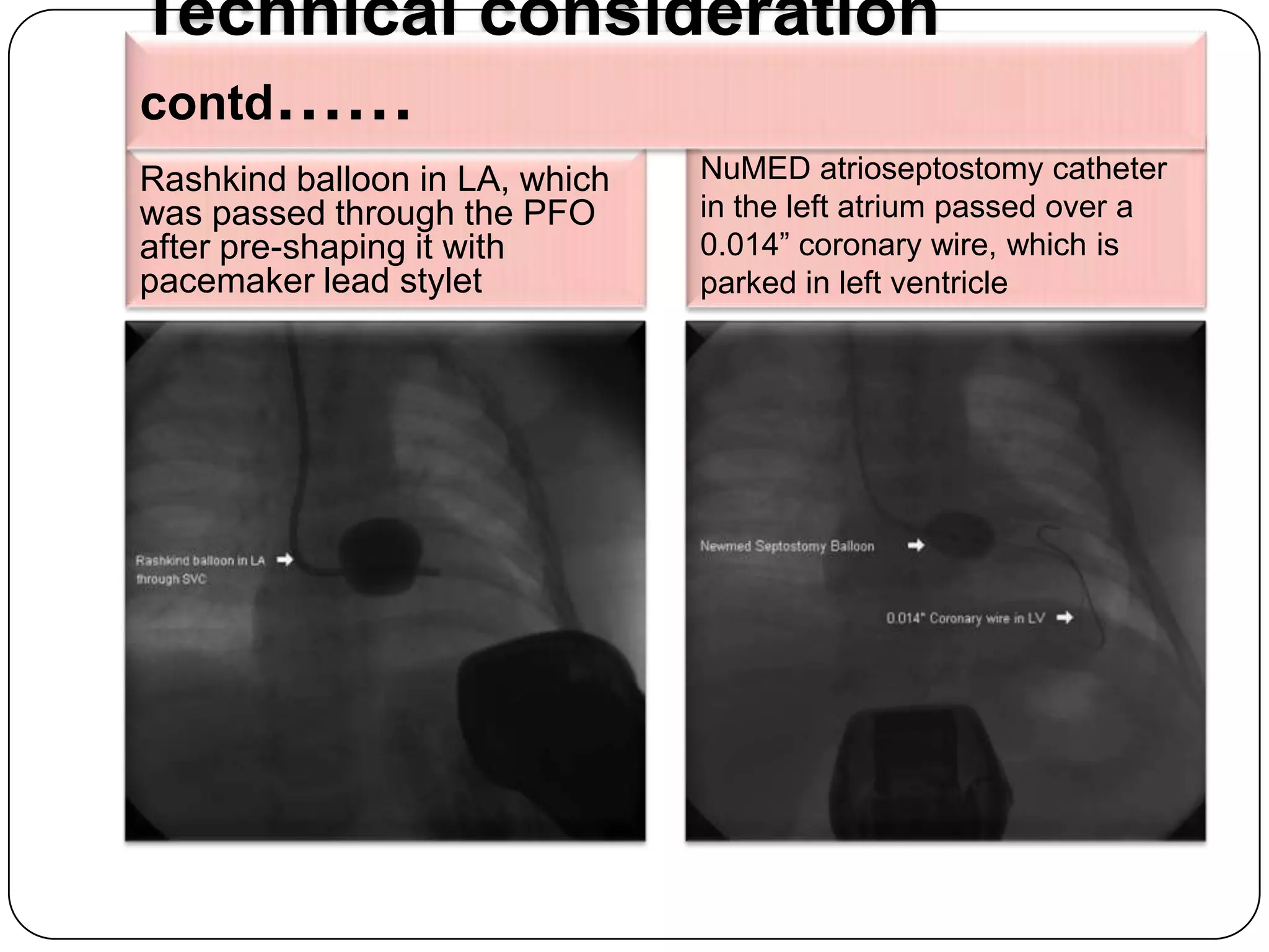Atrial septostomy | PPTX