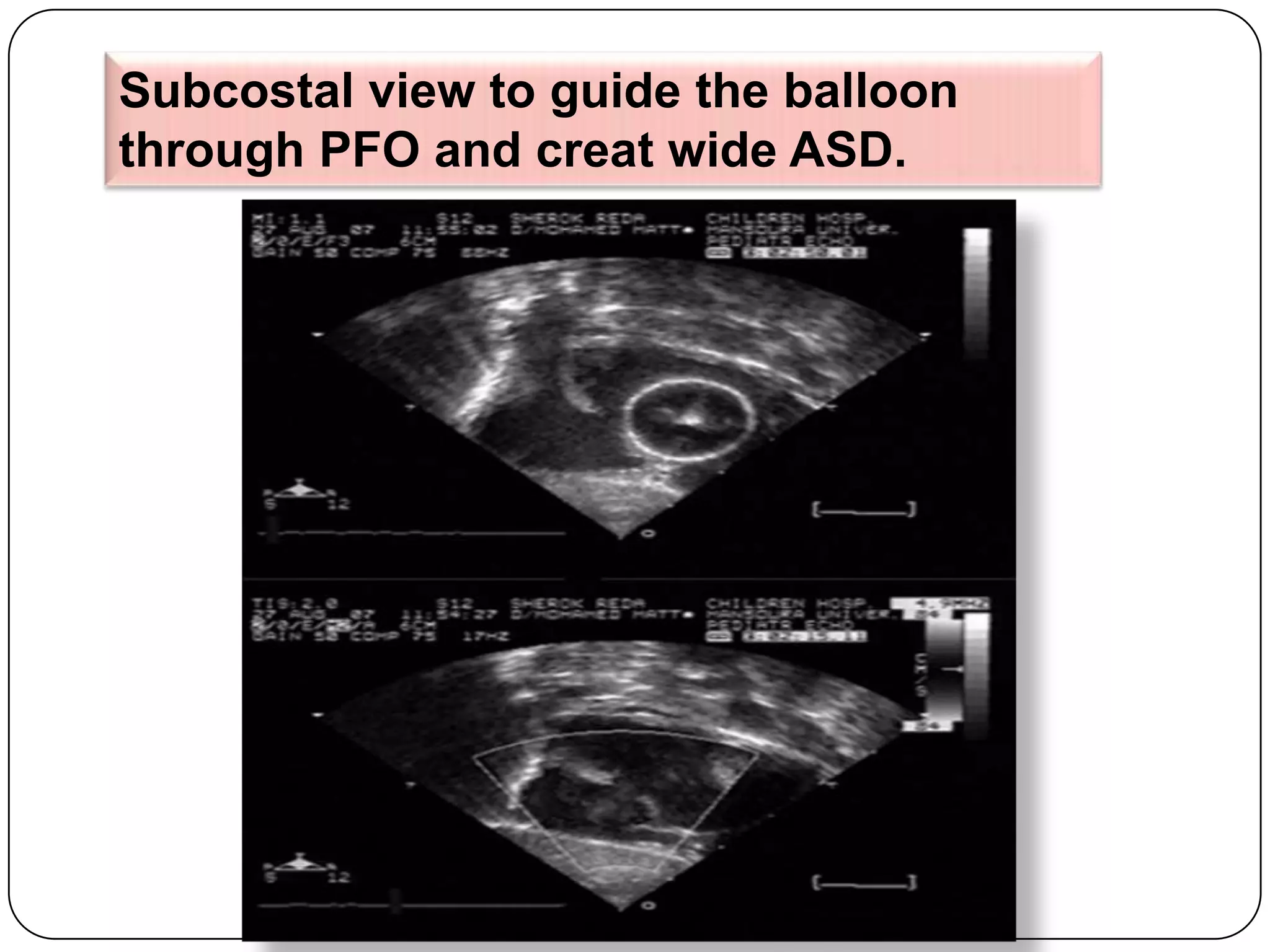 Atrial septostomy | PPTX