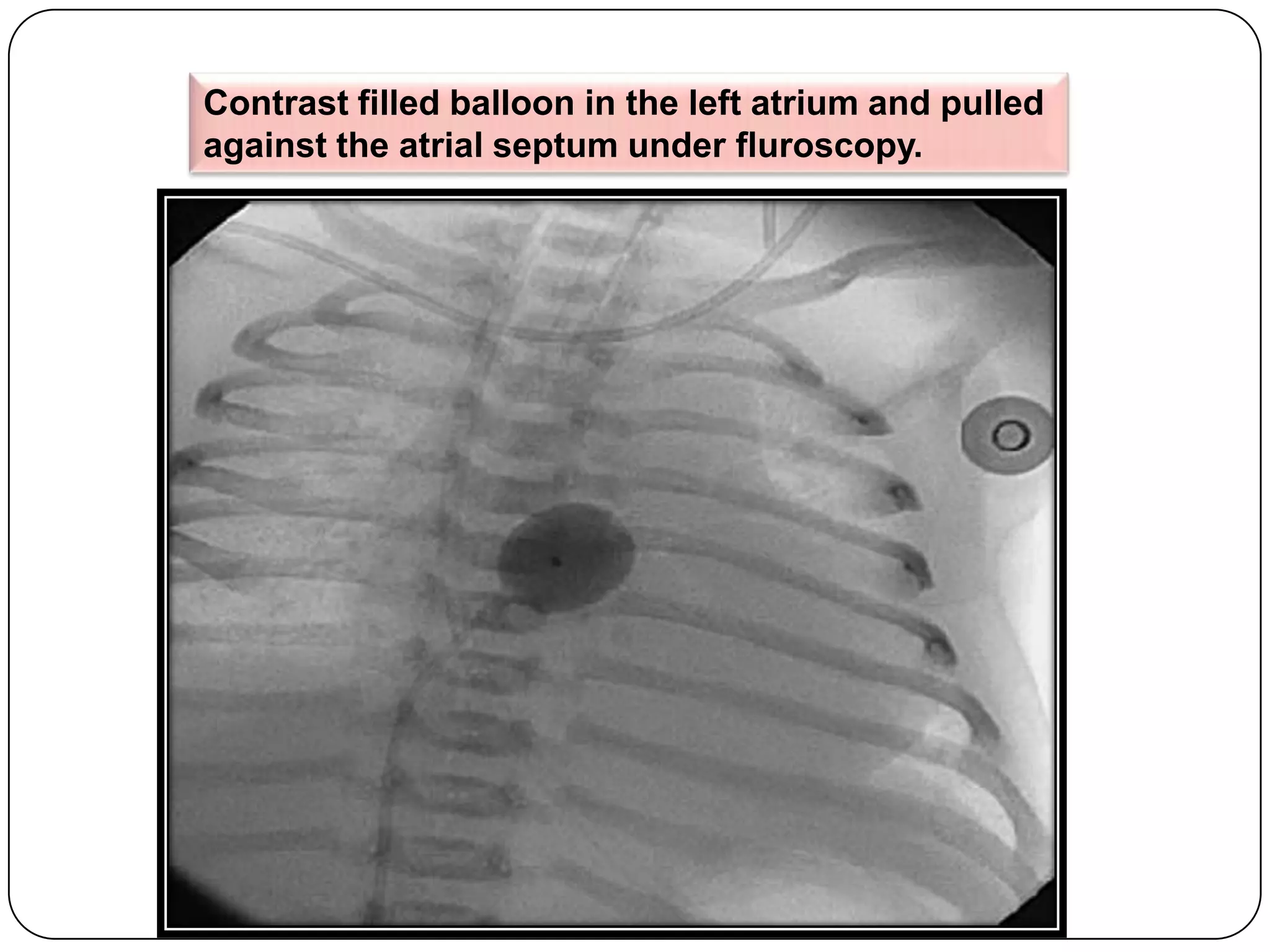 Atrial septostomy | PPTX