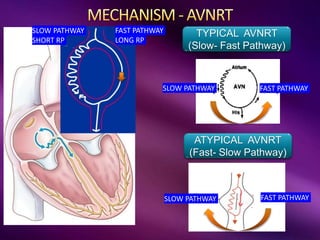 Atrial tachy 26 Oct 22.pptx