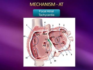 Atrial tachy 26 Oct 22.pptx