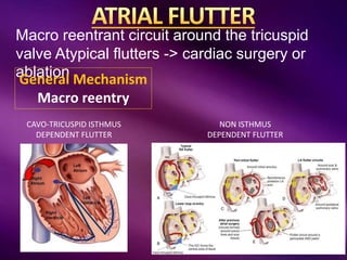Atrial tachy 26 Oct 22.pptx