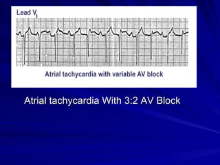 Atrial Tachycardia | PPT